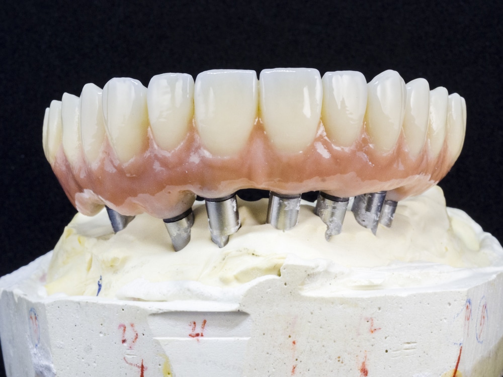 How Implants Can Help Stabilize Dentures | New Smiles Dental